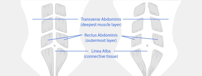 Abdominal Separation (Diastasis Recti) – Katy’s Fitness